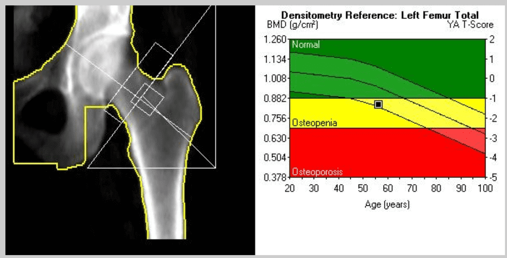 DXA Tests: What you must know