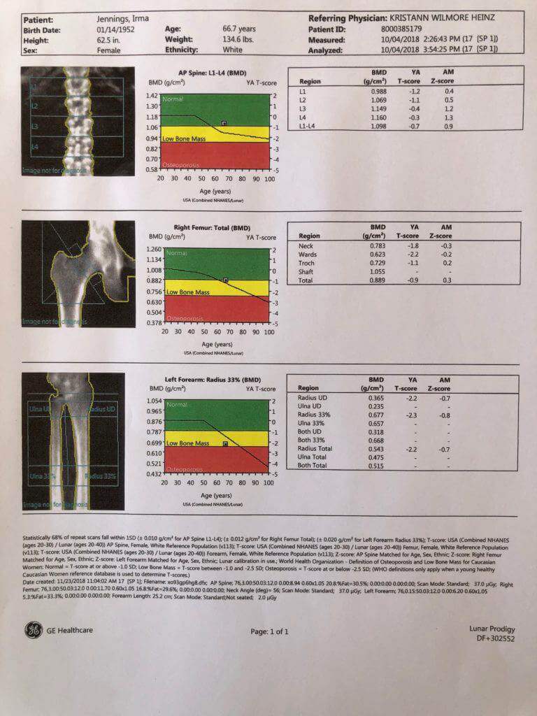 The Proof is in My Bones. Irma Jennings Bone DXA Results